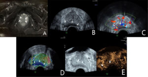 Ultrasound in Prostate Disease: First-Line Imaging for Diagnosis ...