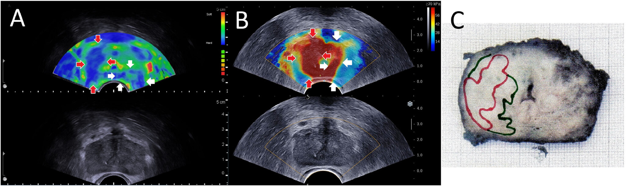 Ultrasound in Prostate Disease: First-Line Imaging for Diagnosis ...